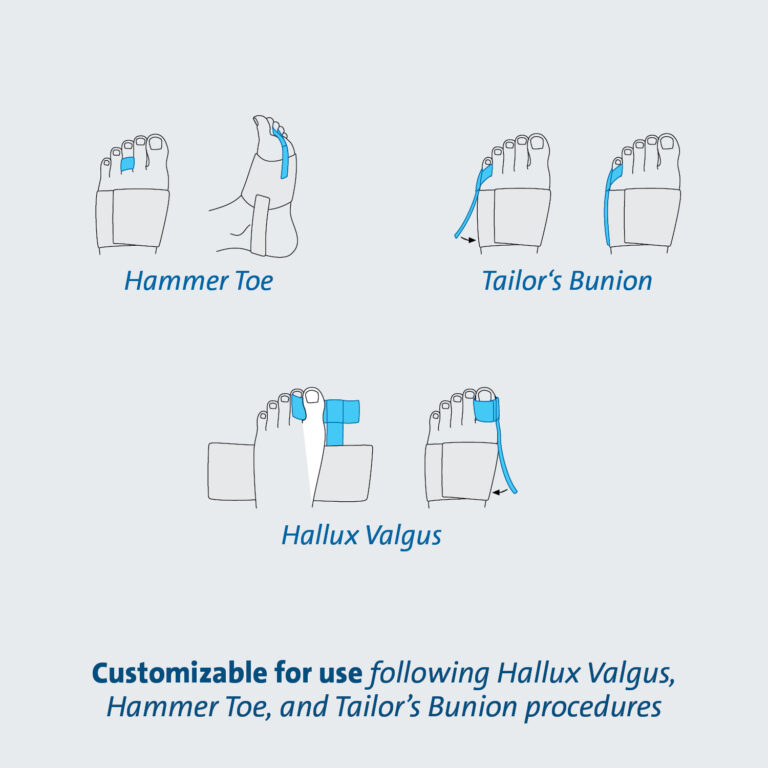 Toe Alignment Splint - DARCO International